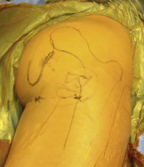 Endoscopic View From The Lateral Portal After Hamstring Bursectomy