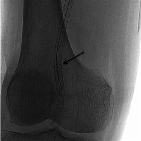 Pdf The Primary Patency And Fracture Rates Of Self Expandable Nitinol Stents Placed In The