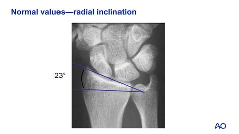 11 Distal Radial Fractures Management Principles Pptx