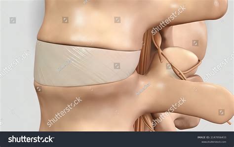 Nerve Compression Syndrome Compression Neuropathy Medical Stock Illustration 2147956433