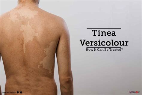 Tinea Versicolor Vs Pityriasis Versicolor At Samuel Zelman Blog
