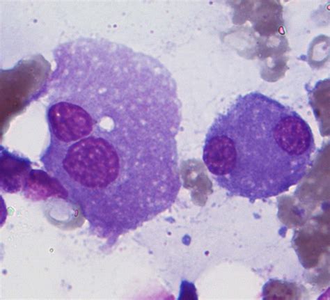Typical Dysplastic Megacaryocytes Download Scientific Diagram