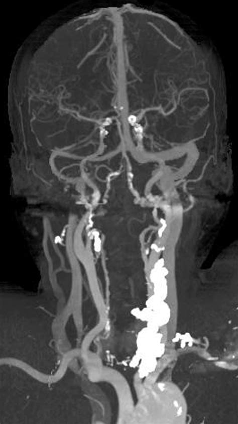 Coarse Calcification Is Seen Anterior To The Left Common Carotid Artery Download Scientific
