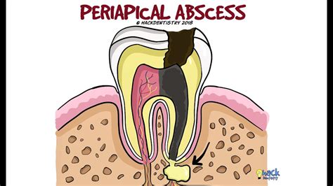 Periapical Abscess Youtube