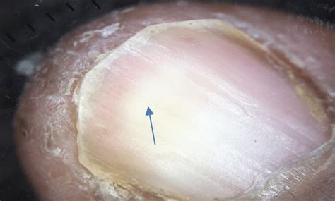 Onychodermal Band Anatomy Bony Pelvis And Lower Limb Toe Nails