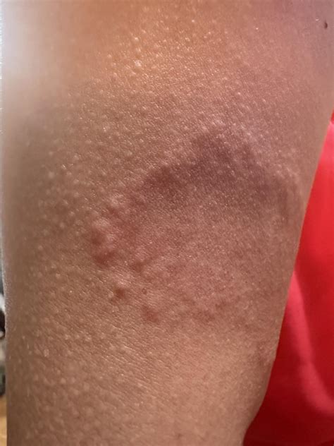 Freaking Out Seroconversion Rash R Hiv