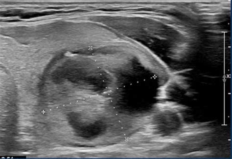 The Radiology Assistant Ti Rads Thyroid Imaging Reporting And Data