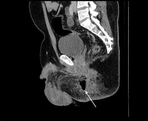 Perianal Abscess Jetem