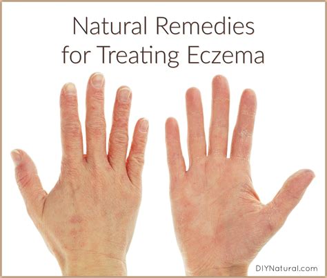 Natural Remedies For Eczema Both Internal And External Tips