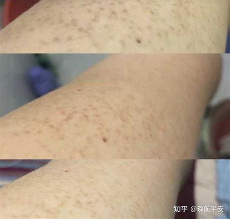 胳膊上其很多小红点是什么 知乎