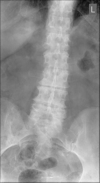 Osteomyelitis X Ray Spine