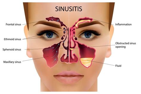 Relieving Sinus With Chiropractic Care Chiropractor Dubai