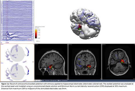 Eeg Source Localization Of Stereotactic Eeg Using Cortico Cortical
