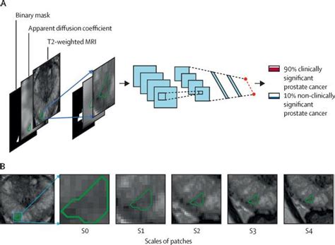 Amogh Hiremath On Linkedin An Integrated Nomogram Combining Deep Learning Prostate Imaging
