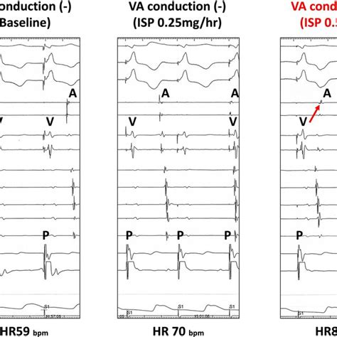 Representative Case Of A Patient Whose Va Conduction Appeared After Download Scientific Diagram