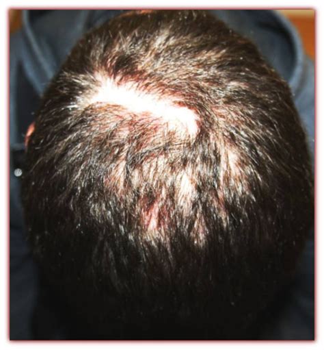 Topical Antibiotics For Genital Folliculitis At Charles Kintore Blog