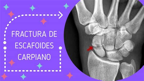 Fractura De Escafoides Carpiano Harumi Ramírez Mendez Udocz