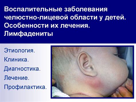 Воспалительные заболевания челюстно лицевой области у детей Особенности их лечения Лимфадениты