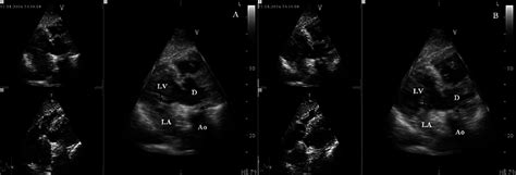 Real Time 3 Dimensional Transthoracic Echocardiography Showed Download Scientific Diagram