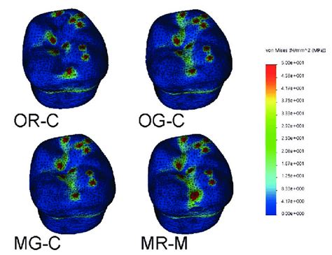 Cavosurface Margin Between Resin Restorations Or C Mr M And Tooth