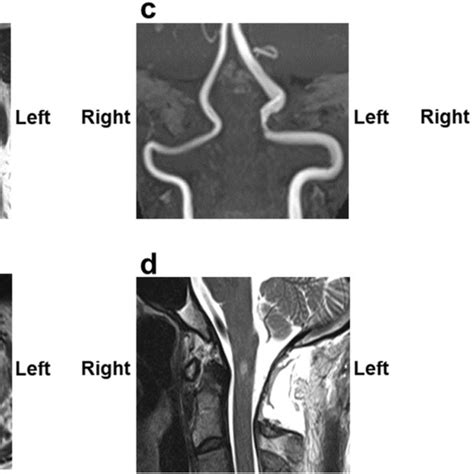 Postoperative Radiological Findings The Left Persistent First Download Scientific Diagram