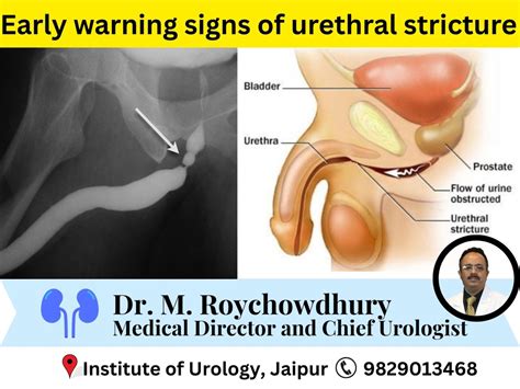 Drawbacks Of Optical Internal Urethrotomy Oiu