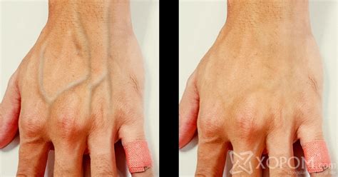 Зарим хүмүүсийн судас яагаад товойж харагддаг вэ Ийм шалтгаантай гэж бодож байсангүй