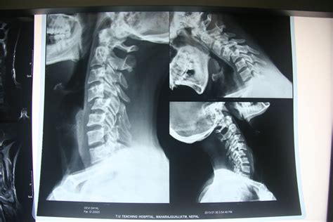 Pre Op X Rays Showing Marked C4 5 Deformity Followed By Post Op Fluoro