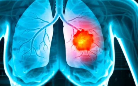 На Острова работят върху първата ваксина срещу рак на белия дроб Lupa Bg