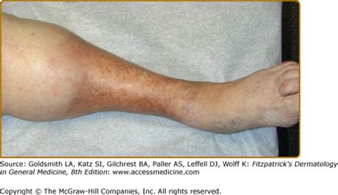 Panniculitis Plastic Surgery Key