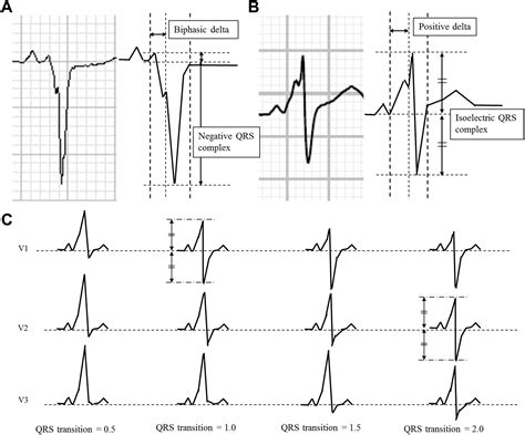 New Algorithm For Accessory Pathway Localization Focused On Screening
