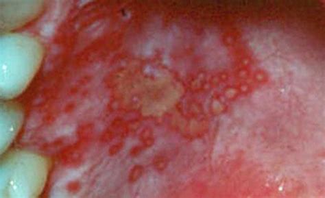 Chlamydia In The Mouth