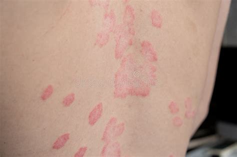 Psoriasis Vulgaris Skin Patches Are Typically Red Itchy And Scaly
