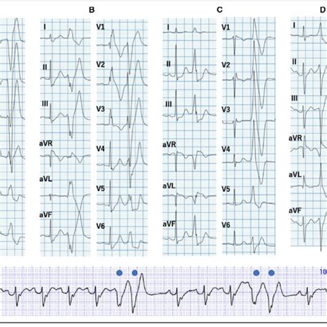 Occurrence Of Premature Ventricular Contractions Pvcs Associated With Download Scientific