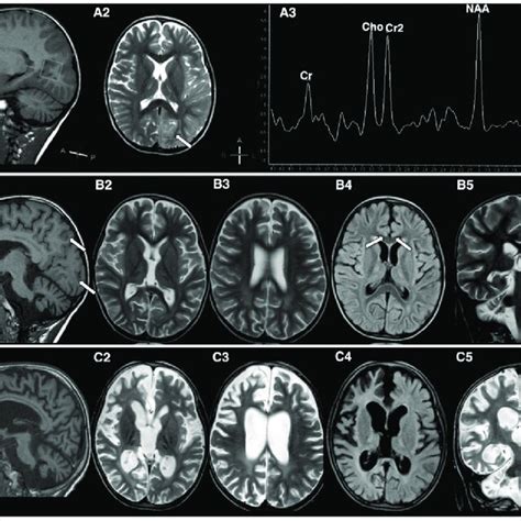 Mri Brain Imaging A Mri Abnormalities In The Acute Stage 48 H From Download Scientific