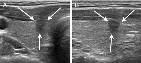 Us Findings Of A Malignant Thyroid Nodule In Underlying Homogenous