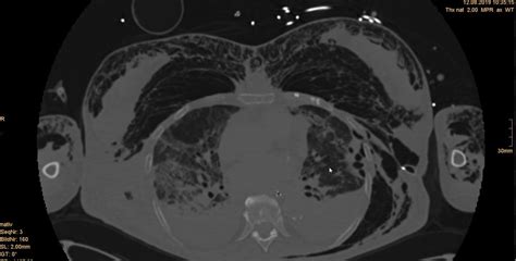 Life After Ptb Rtuberculosis