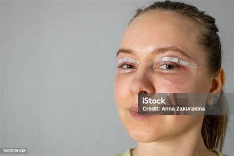 성형 수술 안검 성형술 부은 눈 주머니 제거 가능한 바늘로 절개 부은 피부 및 타박상 눈꺼풀 후 여성의 얼굴 과도한 피부 또는 지방을 제거하는 성형 수술 30 34세에 대한