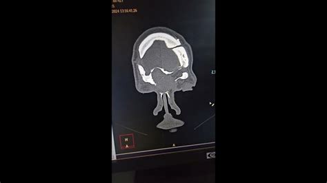 Ahilasamy N On Linkedin Very Rare Case Non Sinogenic High Septal Mucocele