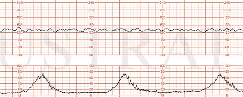Stock Template Fetal Strips Iv Fetal Strip Library From Courses