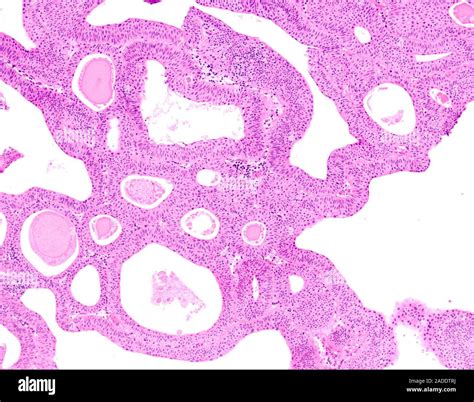 Light Micrograph Of Low Grade Papillary Urothelial Carcinoma Also Known As Transitional Cell