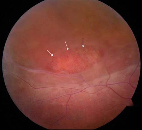 Retinoschisis Causes Symptoms Diagnosis And Retinoschisis Treatment