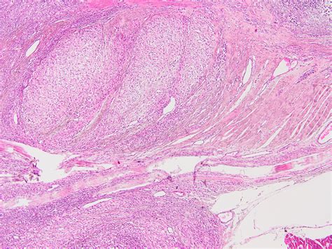 Pathology Outlines Clear Cell Sarcoma Of Soft Tissue