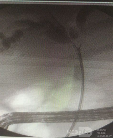 Direct Cold Forceps Biopsy From Hillar Cholangiocarcinoma Under Fluoroscopy • Image •