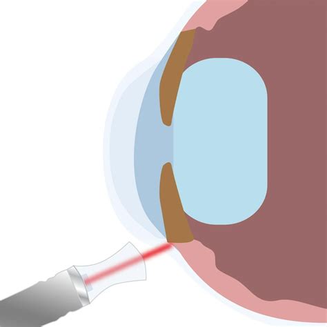 Glaucoma Monterey Ca Salinas King City Monterey County Eye