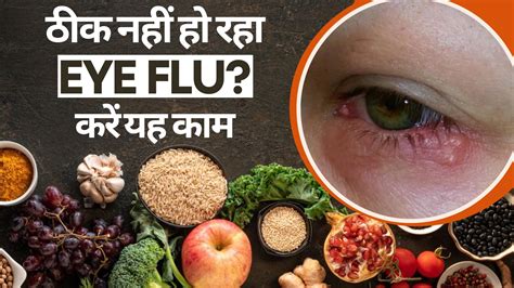 Eye Flu Prevention Tips ठीक नहीं हो रहा Eye Flu करें यह काम मिलेगा