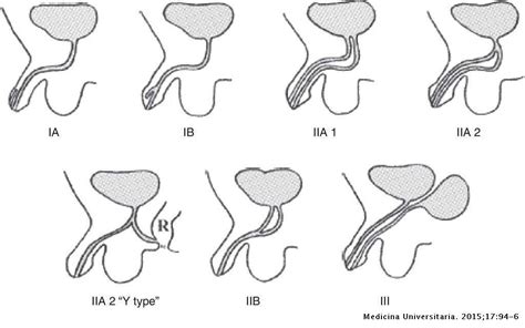 Decision Making In The Management Of An Incomplete Urethral Duplication In A Young Male