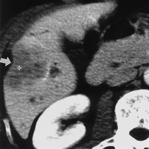 Cholangiocarcinoma Pictorial Essay Of Ct And Cholangiographic Findings