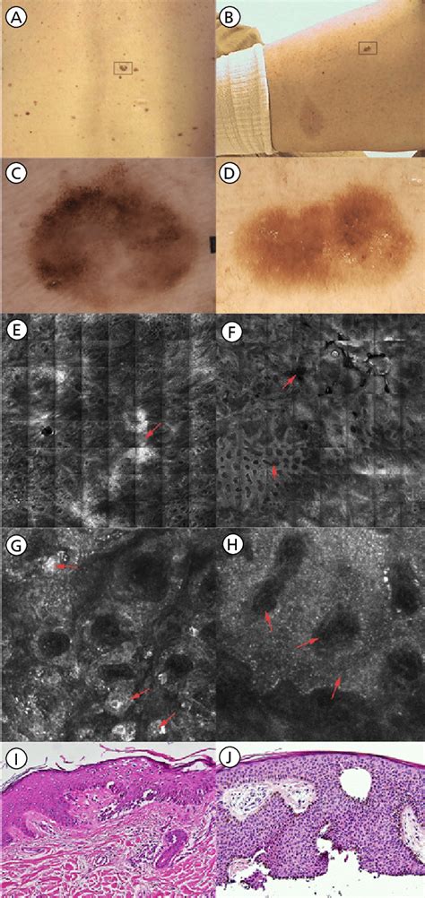 Hyperpigmented Macule On Back 3a Asymmetrical Globular Lesion With Download Scientific