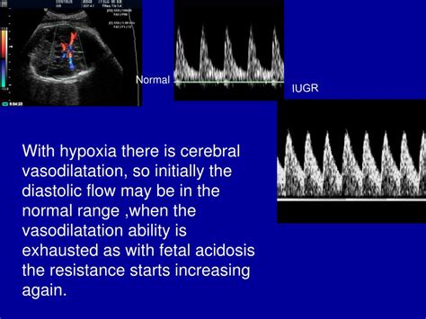 Ppt Middle Cerebral Artery Doppler Powerpoint Presentation Free